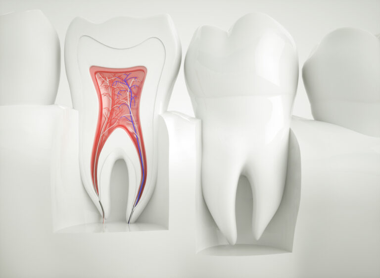 Can you avoid a root canal treatment? - Harvard Square Dental